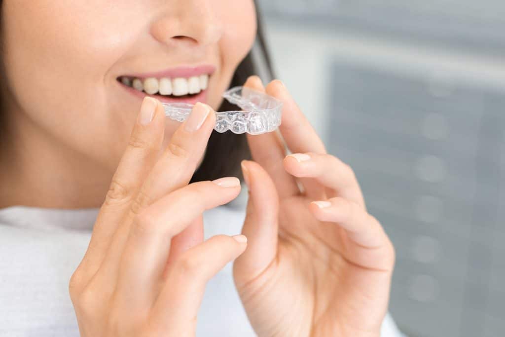 How Does Invisalign Work? | Dental Solutions | Guelph, ON