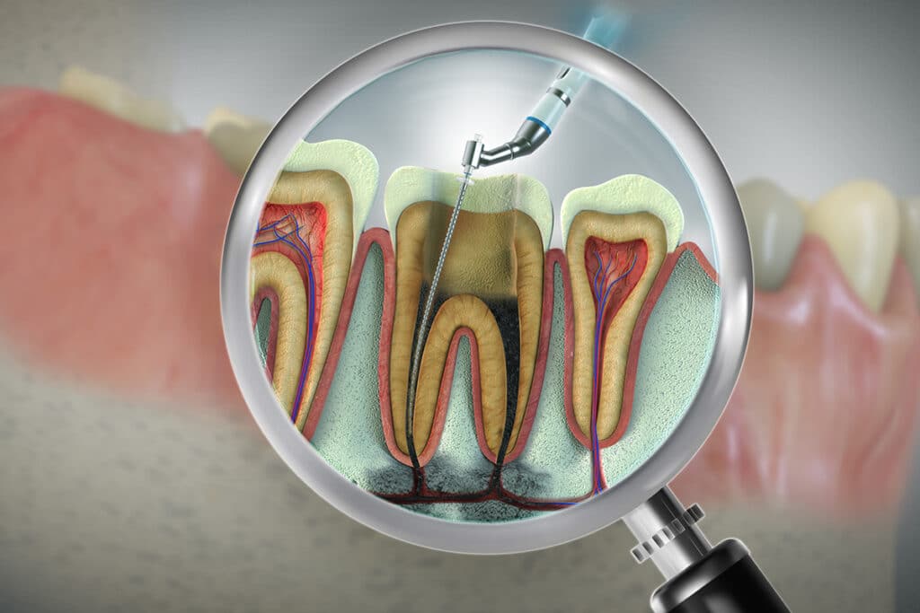 Root Canal Healing: Signs & When to Call Your Dentist - Bisson Dentistry